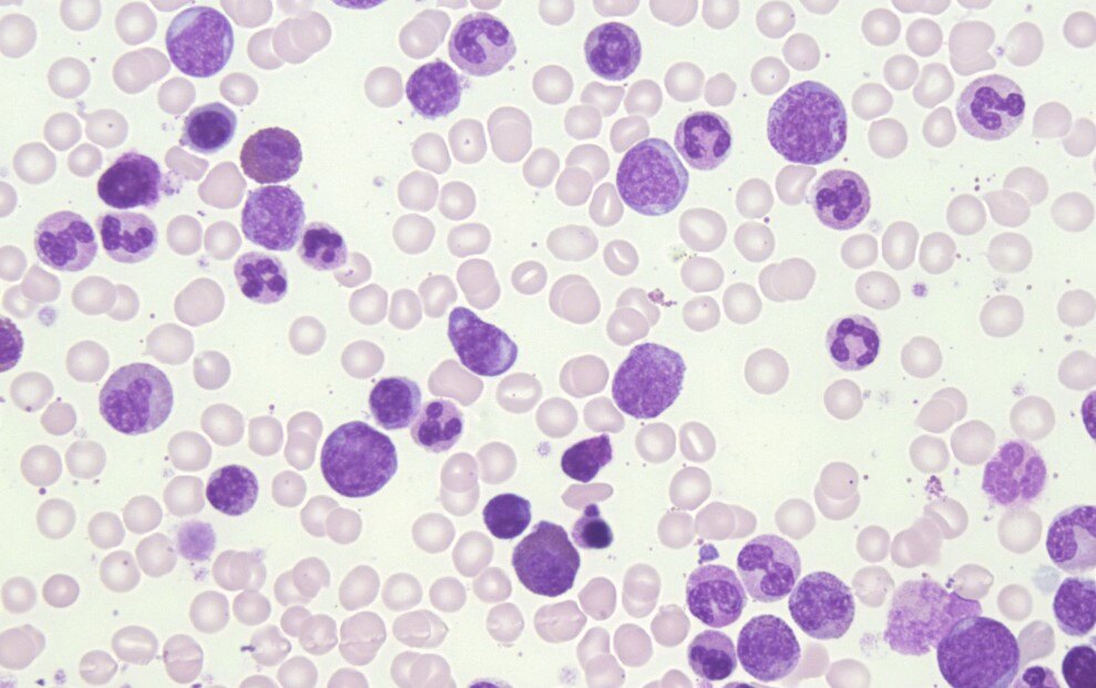 Advanced Imaging and AI in Leukemia Diagnosis: Enhancing Accuracy and Care