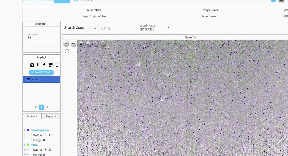 The Role of Smudge Cells in Chronic Lymphocytic Leukemia Diagnosis