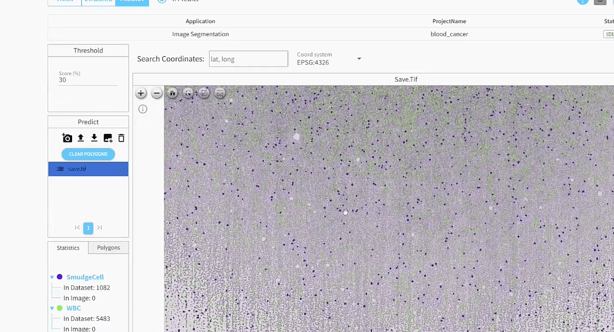 The Role of Smudge Cells in Chronic Lymphocytic Leukemia Diagnosis