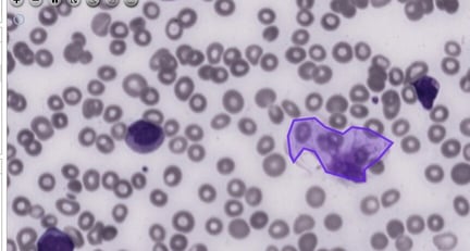 The Role of Smudge Cells in Chronic Lymphocytic Leukemia Diagnosis